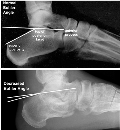Calcaneus Fractures - Trauma - Orthobullets